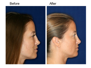 Permanent Micro-Droplet Silicone Injections for Botched Nose Jobs Still ...