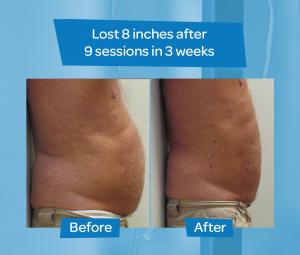 Laser Lipo Now Available in Stuart