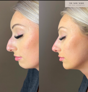 Instant Nose Jobs are Gaining Popularity - Hereâ€™s Everything To Know ...