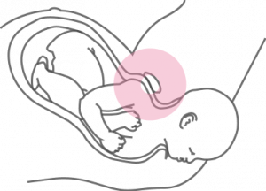 FetalEase Granted Investigational Device Exemption (IDE) Approval for ...