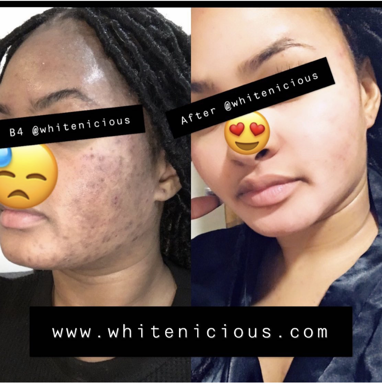 Whitenicious Before And After Blac Chyna To Launch Skin Lightening