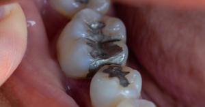The Latest Scientific Review Research on Mercury Dental Amalgam & the ...