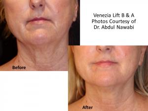 Lasering USA to demonstrate Venezia Lift at The Aesthetic Show