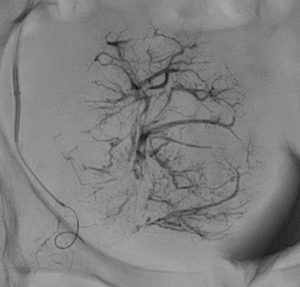 New Embolic Device for Tumor Treatment and Other Oncology Uses Given ...