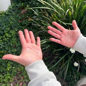 Kids Struggling with Hyperhidrosis as More Parents Notice Excessive ...