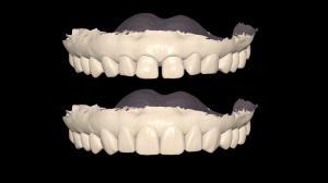 Digital Esthetic Designs Announces Advanced Digital 3D Wax-Up Services