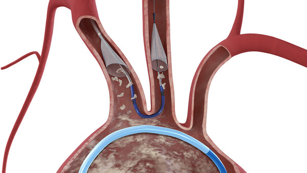 Embolic Protection Devices Market Current Applications, Challenges, and ...