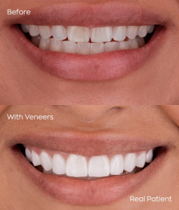 Dental Work in Mexico Is Bringing More Americans to Cancun And The ...